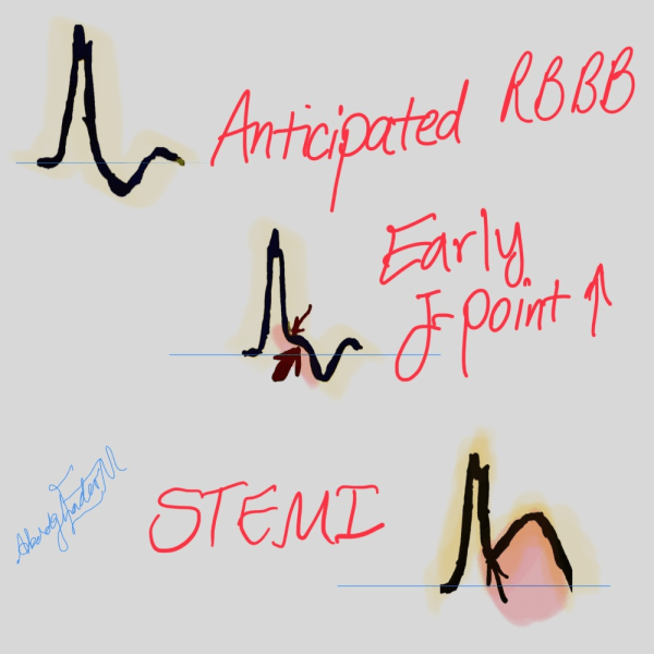 Understanding Right Bundle Branch Block: Key ECG Insights