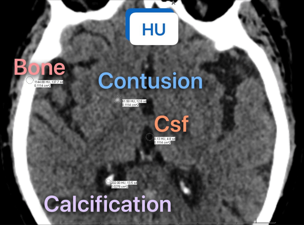 Understanding Hounsfield Units for CT Scan Interpretation
