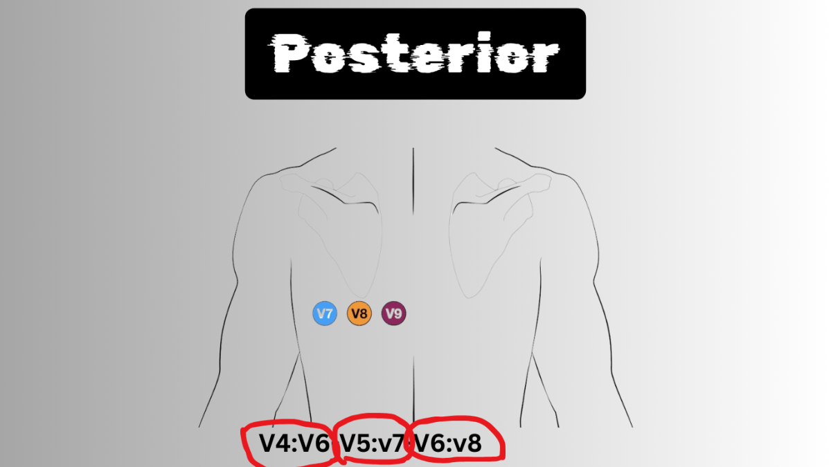 Understanding Inferior STEMI: RV and Posterior Involvement