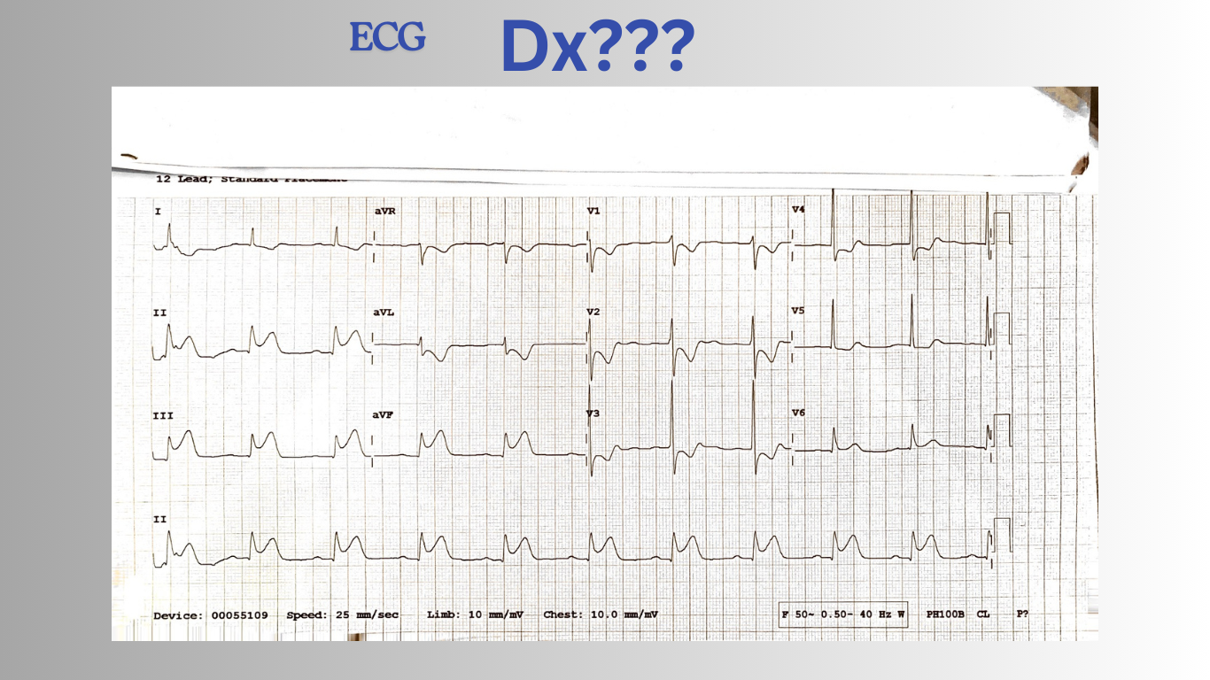 Understanding Inferior STEMI: RV and Posterior Involvement