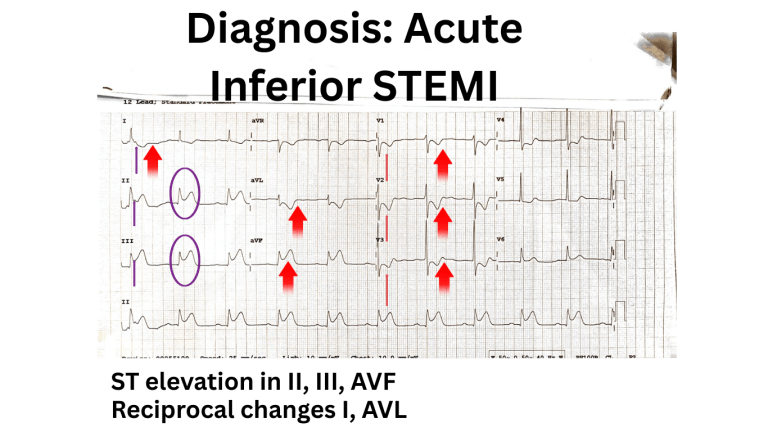 Understanding Inferior STEMI: RV and Posterior Involvement