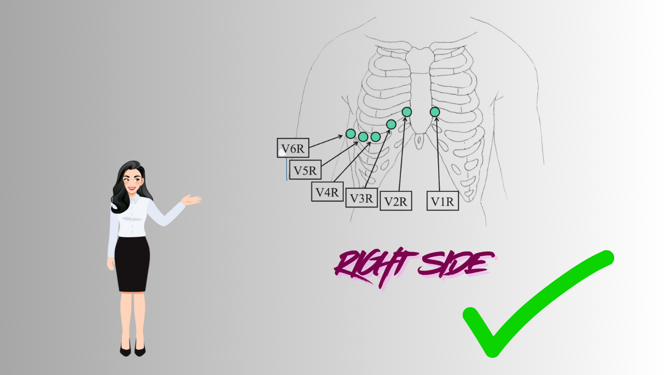 Understanding Inferior STEMI: RV and Posterior Involvement