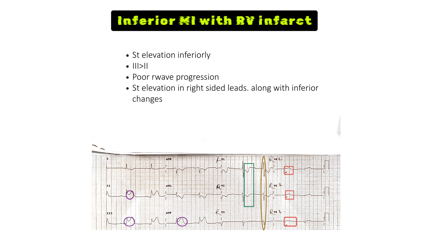 Understanding Inferior STEMI: RV and Posterior Involvement